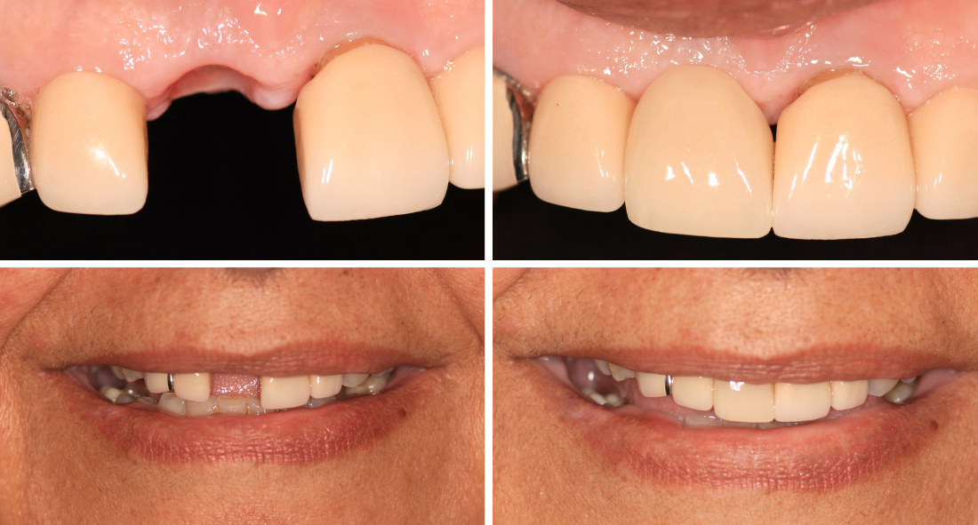 Front Implant Crown | Dental Implants - All-on-4® Harlingen TX